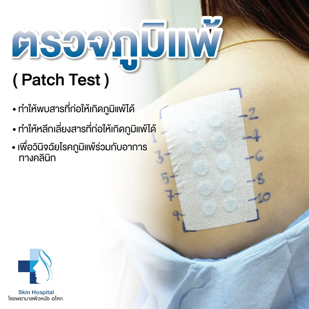 Patch test (การทดสอบภูมิแพ้ทางผิวหนัง) — Asoke Skin Hospital โรงพยาบาล ...