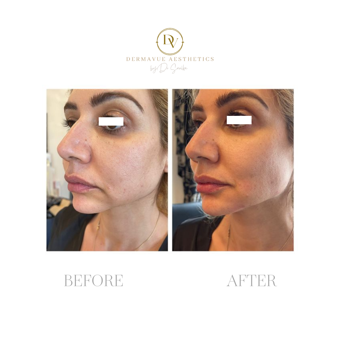 Jaw Line Fillers — Dermavue Aesthetics