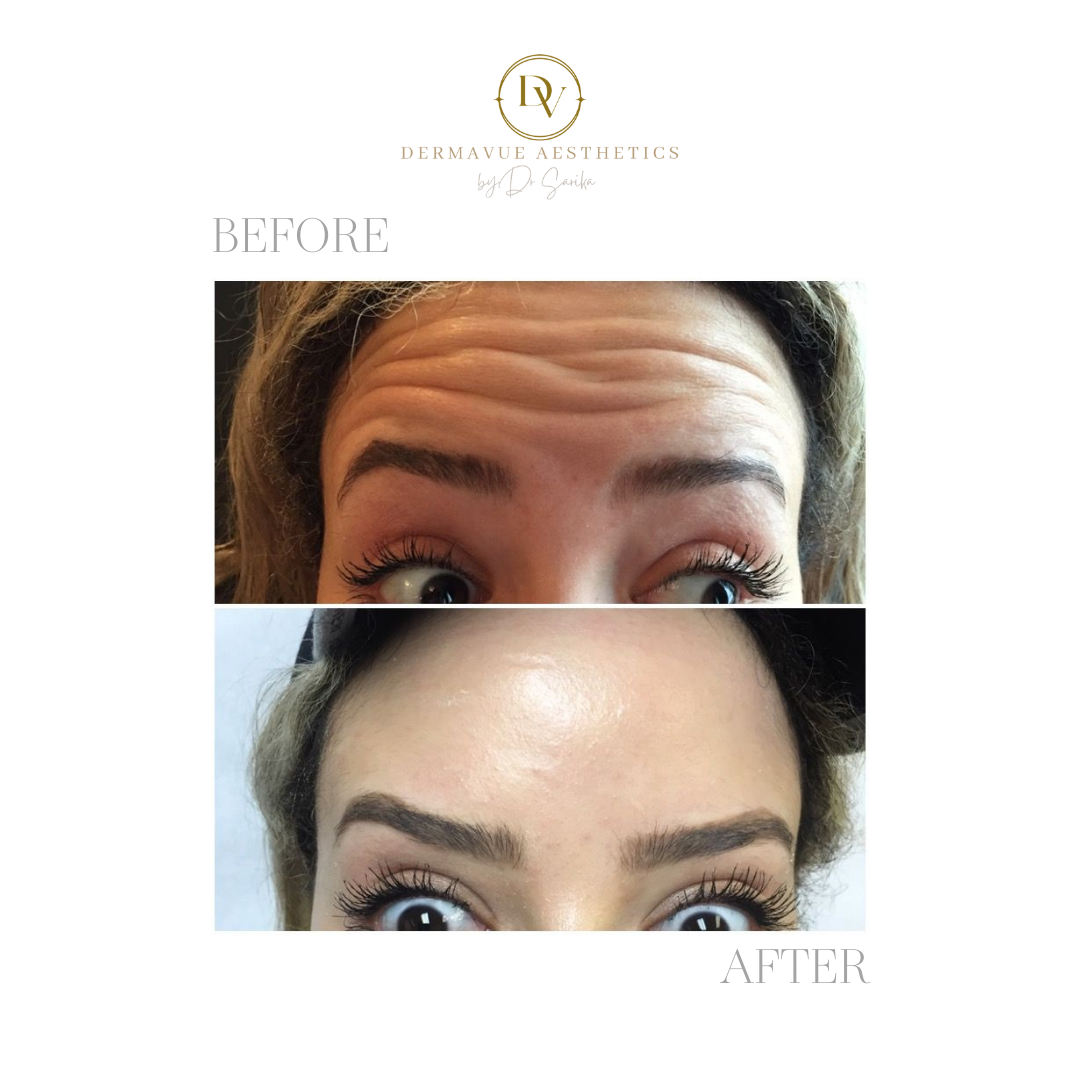 Forehead lines — Dermavue Aesthetics