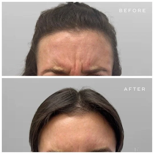 Natural-Looking Botox | Laser Touch Medical Clinic