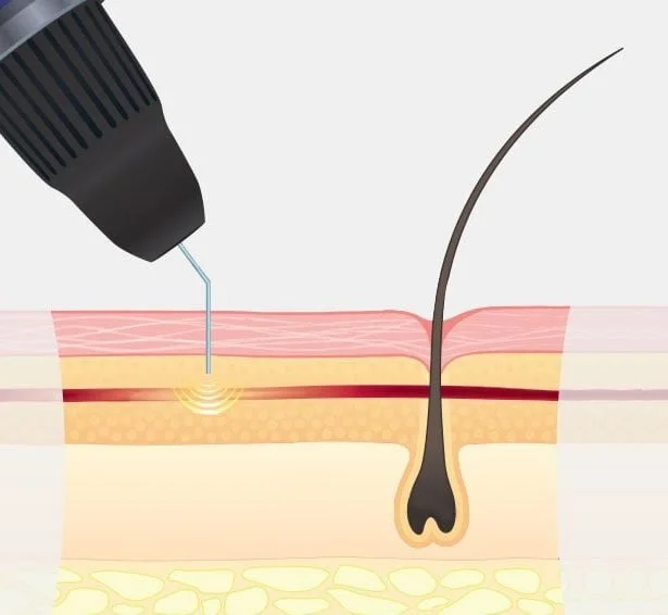 Veinwave Treatment in Los Angeles | Laser Touch Medical Clinic