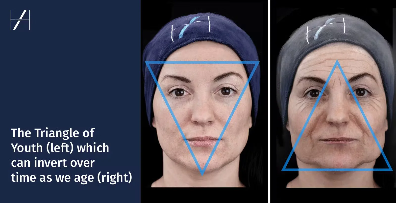 The Triangle of Youth: Understanding Facial Aging and How to Reverse It ...