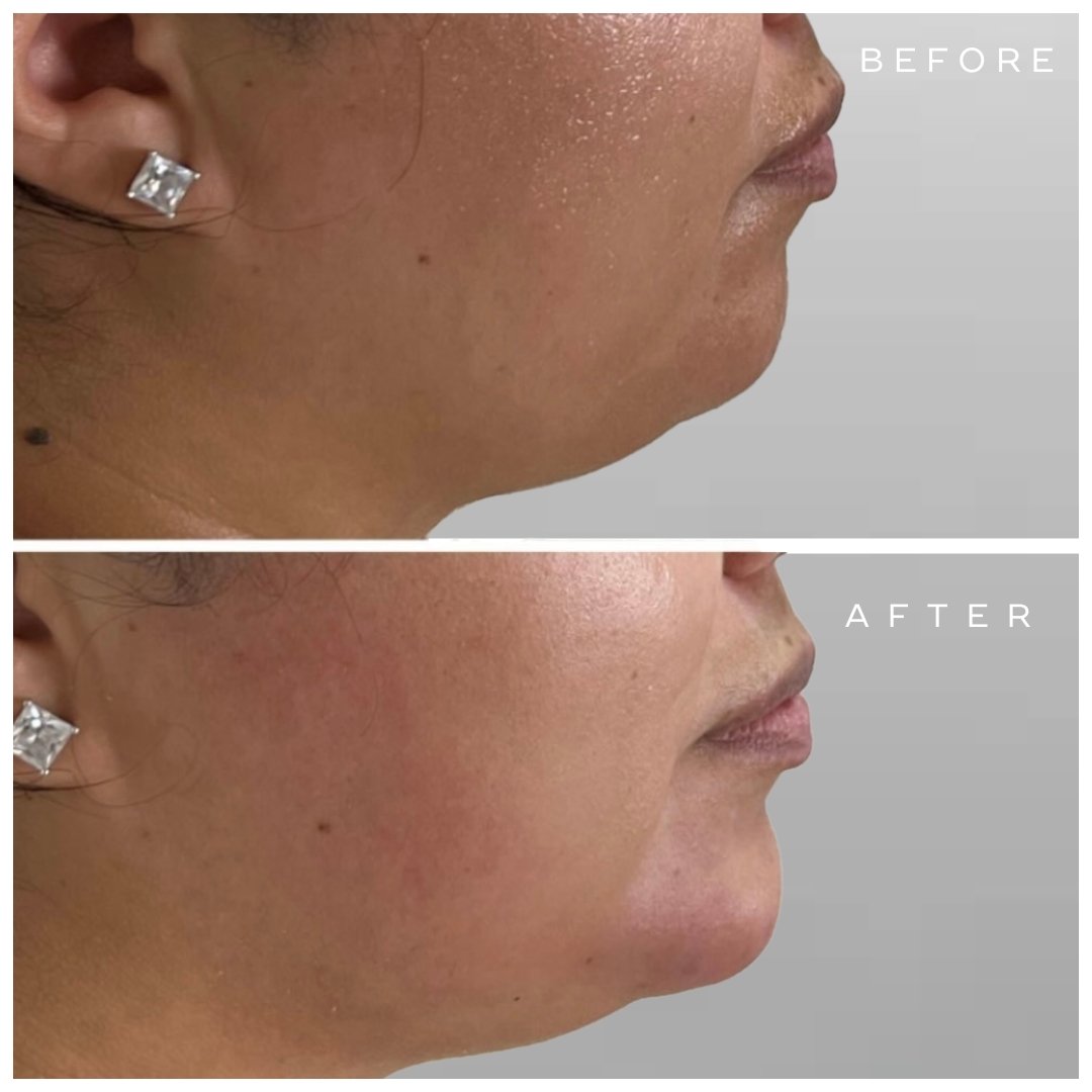 Permanent Double Chin Reduction | Laser Touch Medical Clinic