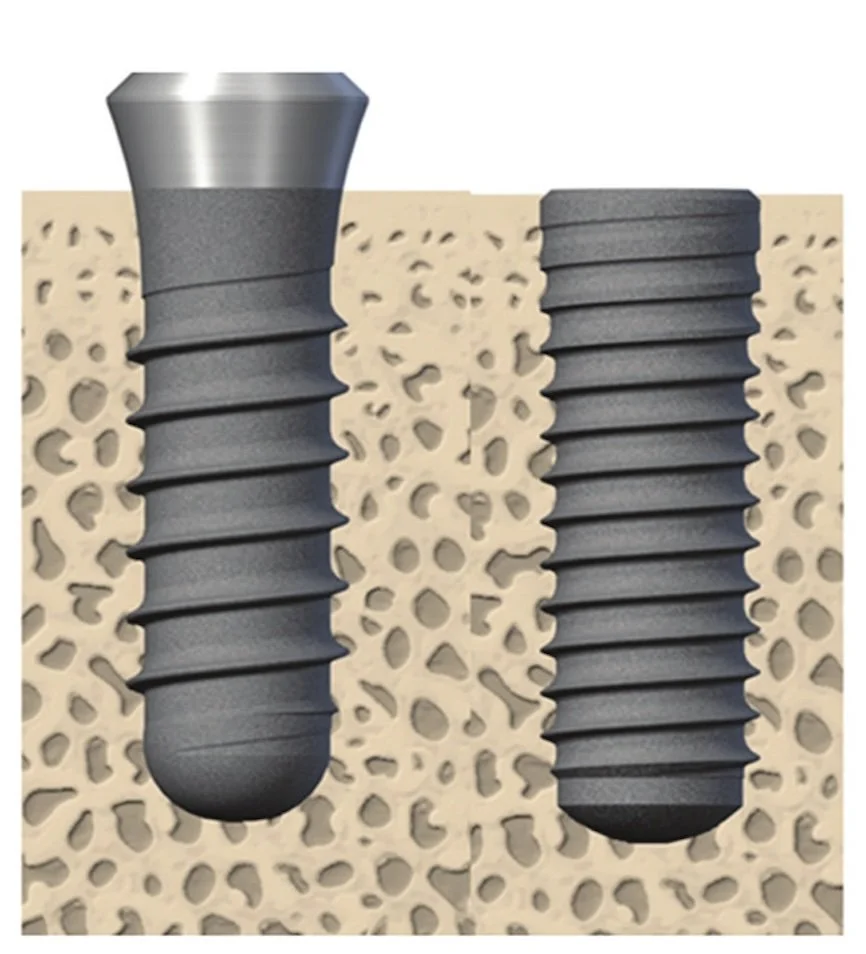 What is a Dental Implant — North Peace Dental and Implant Centre