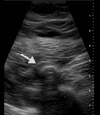 Retained Bullet Resources — The Bullet Related Injury Clinic (BRIC)