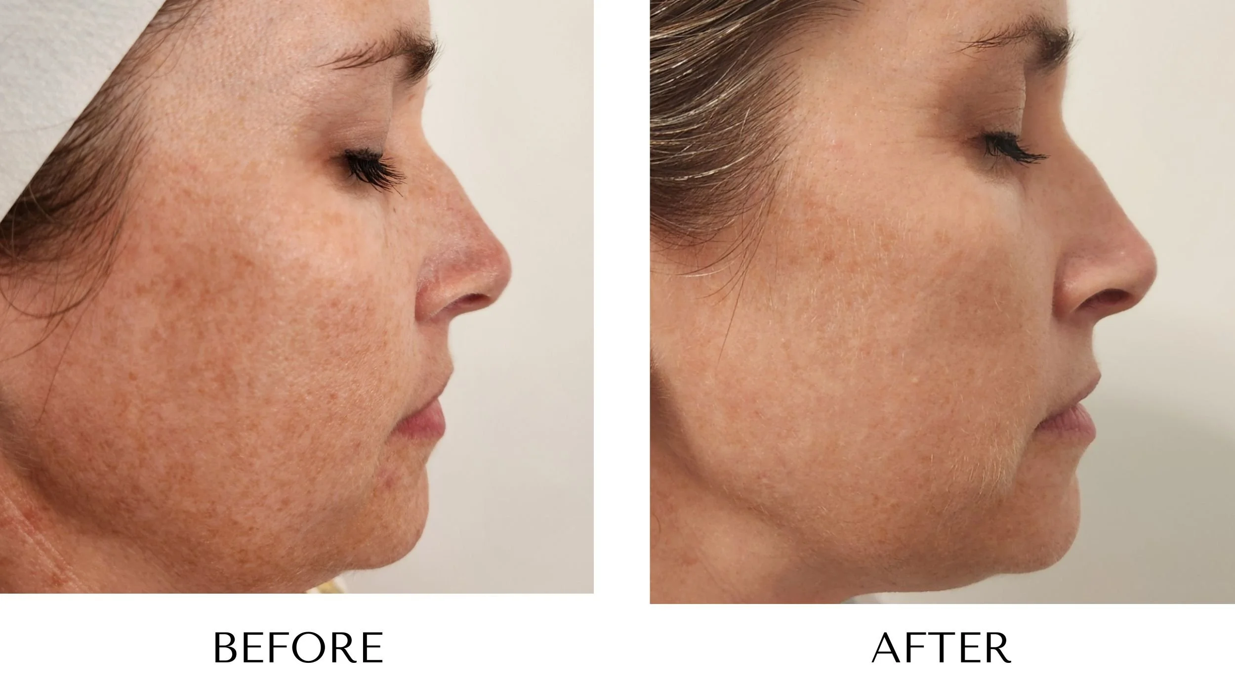NUYU Laser & Skin Rejuvenation | Belleville, Ontario