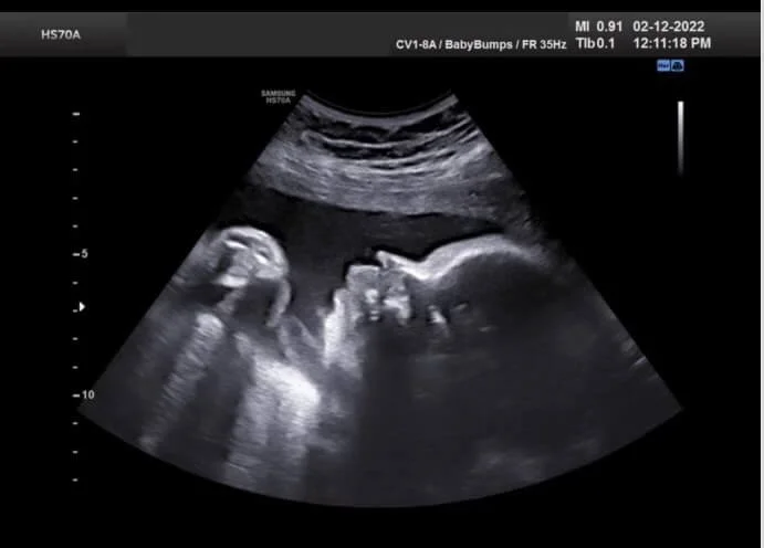 Baby Bumps & Beyond 4D Studio — Gallery