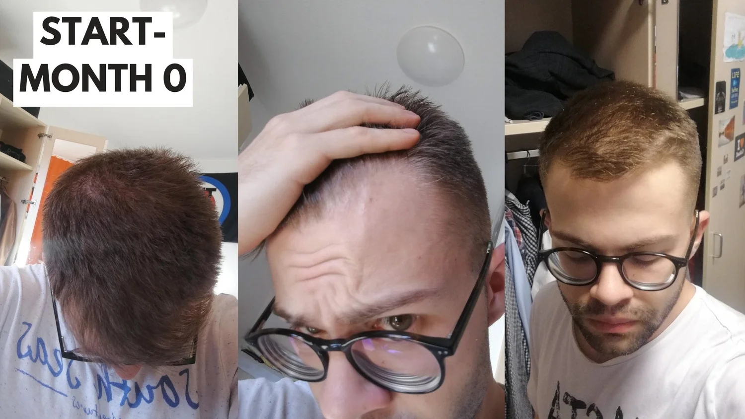 My Finasteride Hair Regrowth Success Story (Month-by-Month Results ...