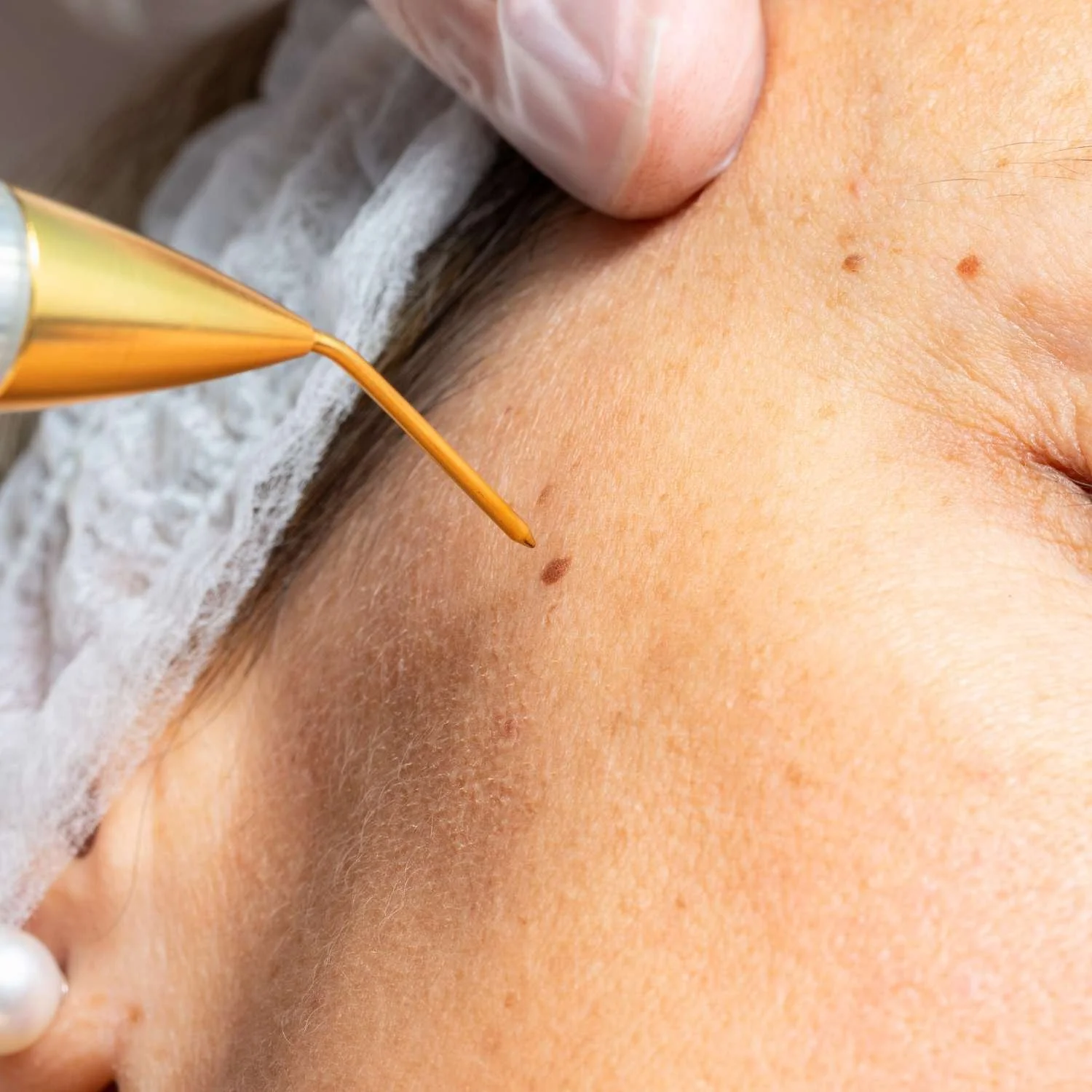 Plasma Pen Skin Tightening | Pure Clinic — Pure Clinic