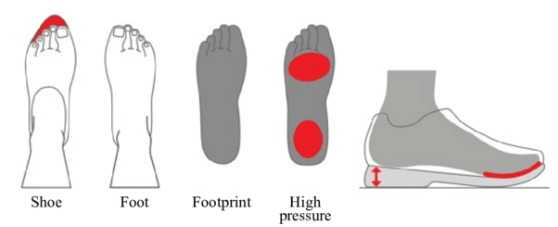 The Top Five Reasons Your Plantar Fasciitis Keeps Coming Back — Solving ...