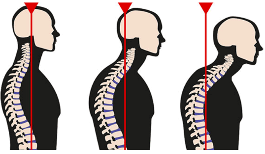 The Best Treatment for Arthritis In the Neck — Solving Pain With ...