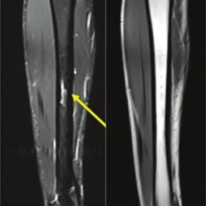 Bone Stress Injuries (BSI) in Runners — The Injury and Performance Clinic
