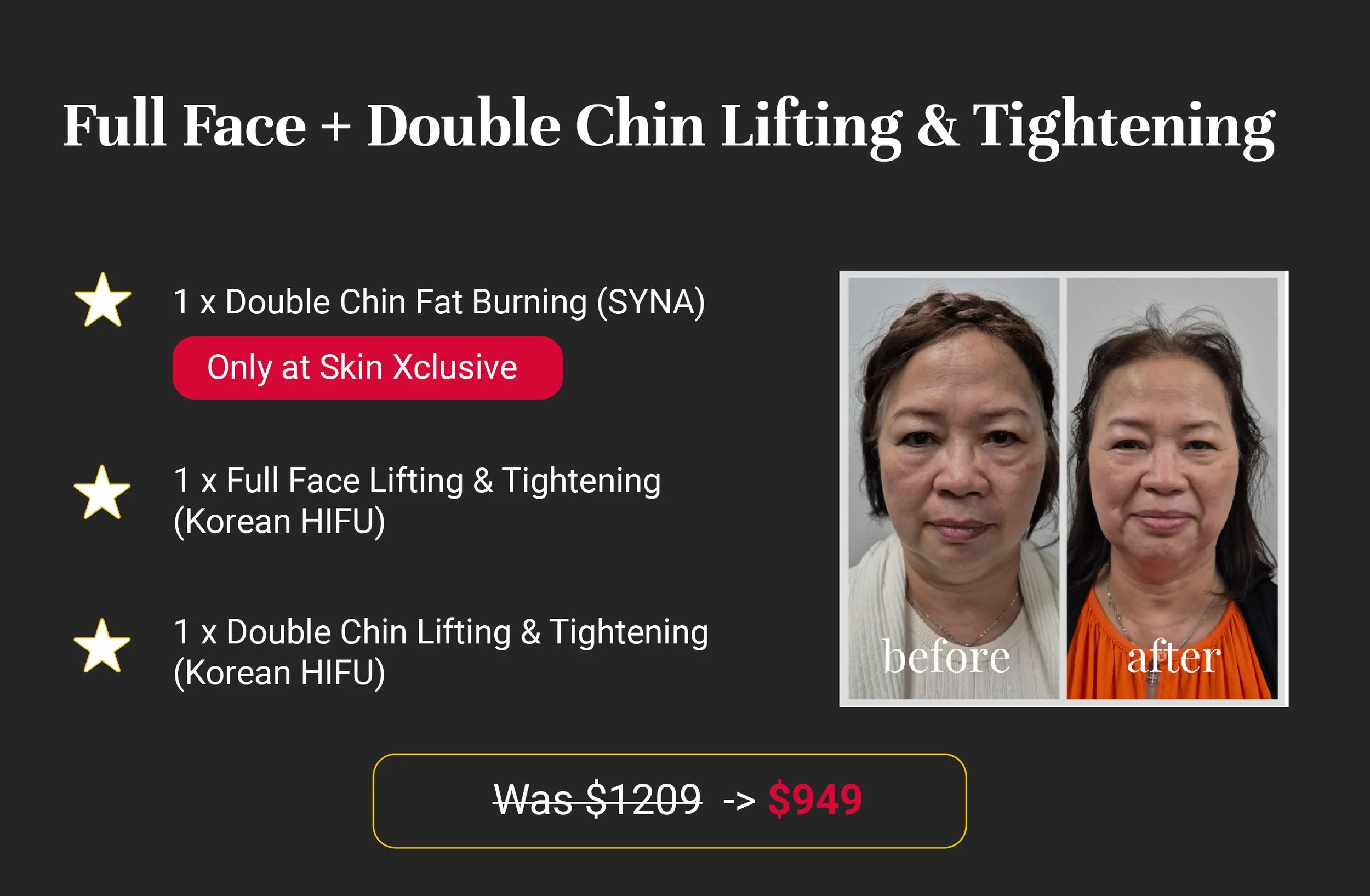 HIFU Promotions at Skin Xclusive — Skin Xclusive
