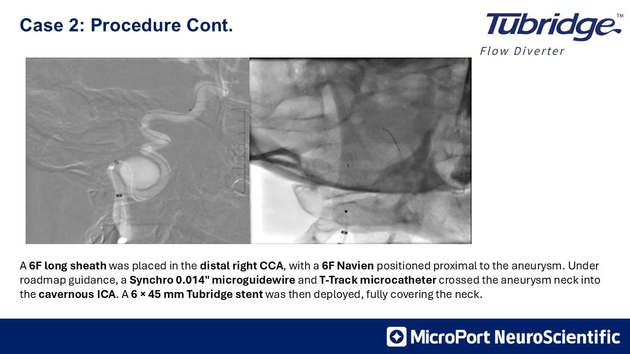 Tubridge Case 2 — Microport Neuroscientific