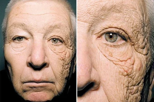 Solar Elastosis - How It Affects Your Skin — Fresh Aesthetics | Botox ...