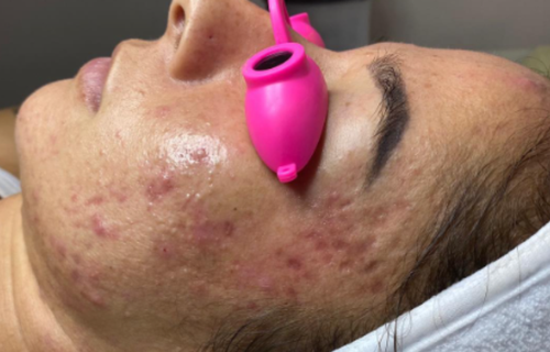 Clogged Pores: Signs, Causes & How to Clear Them Fast