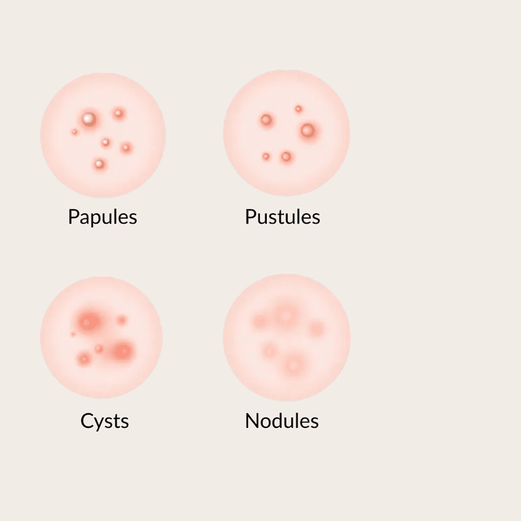 Clogged Pores: Signs, Causes & How to Clear Them Fast