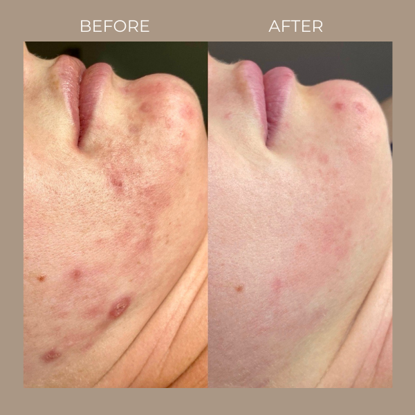 Lucky Skin Giveaway: Win a Free Acne Treatment - Skin Bliss