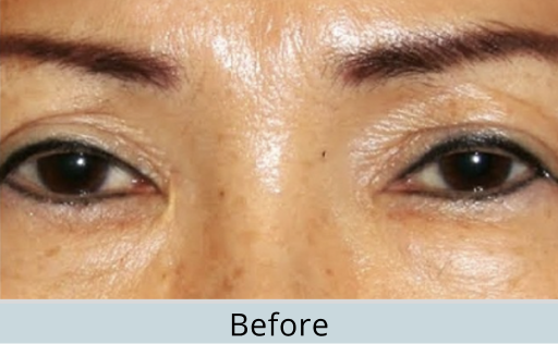 Before & Afters — Bright Eyes MD