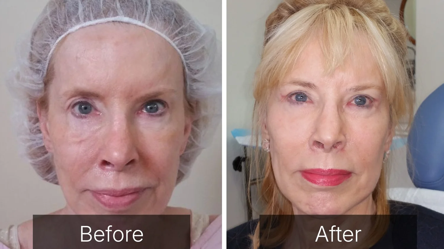 Before & Afters — Bright Eyes MD
