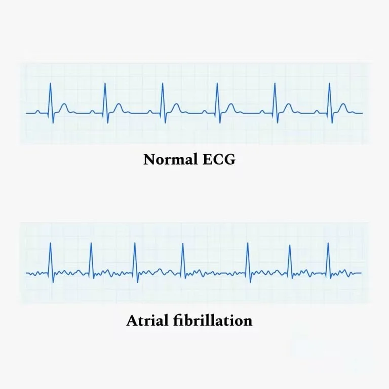 Don't Miss a Beat: September is AFIB Awareness Month - ACLS Academy ...