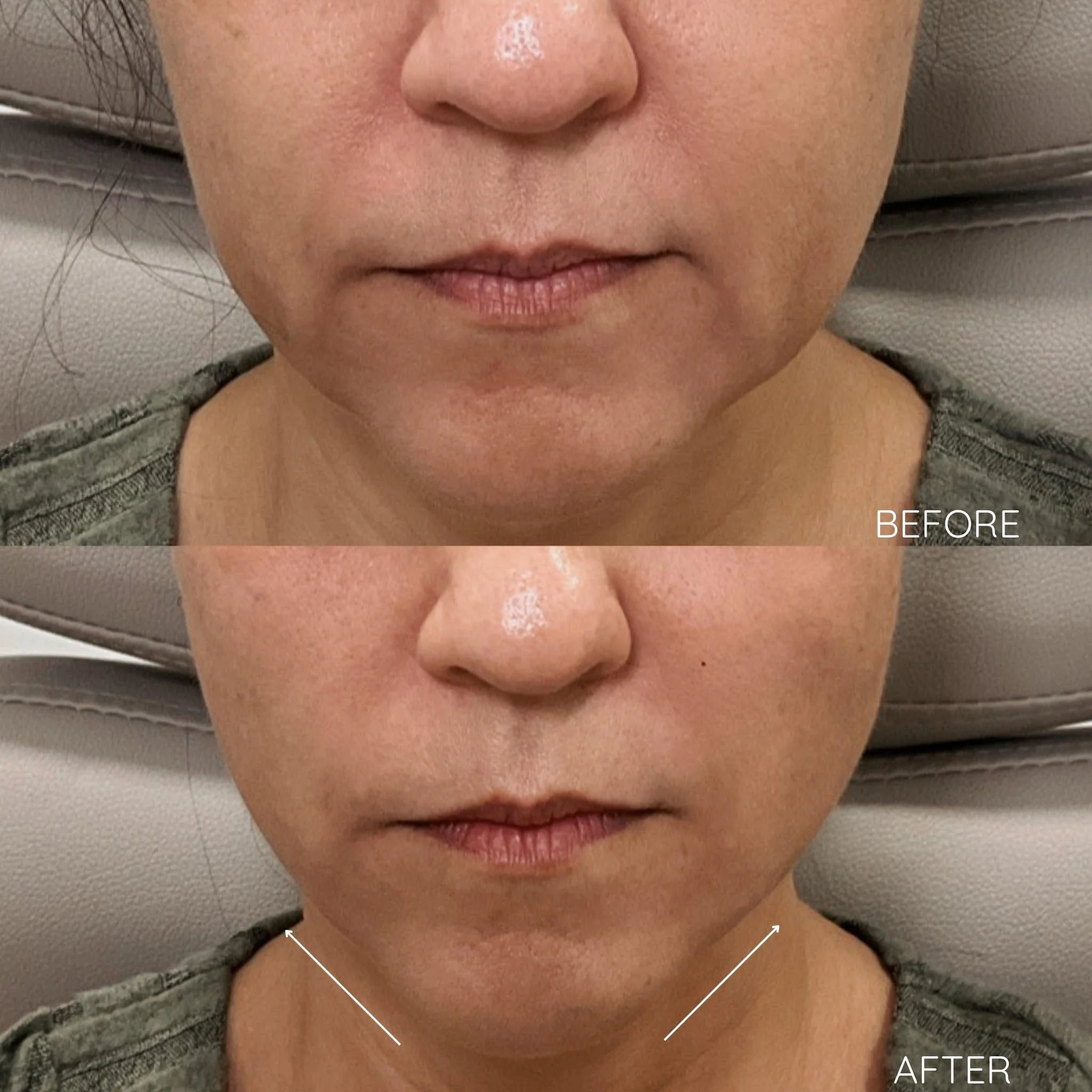 Botox & Filler — The Wellnest | Mililani Med Spa