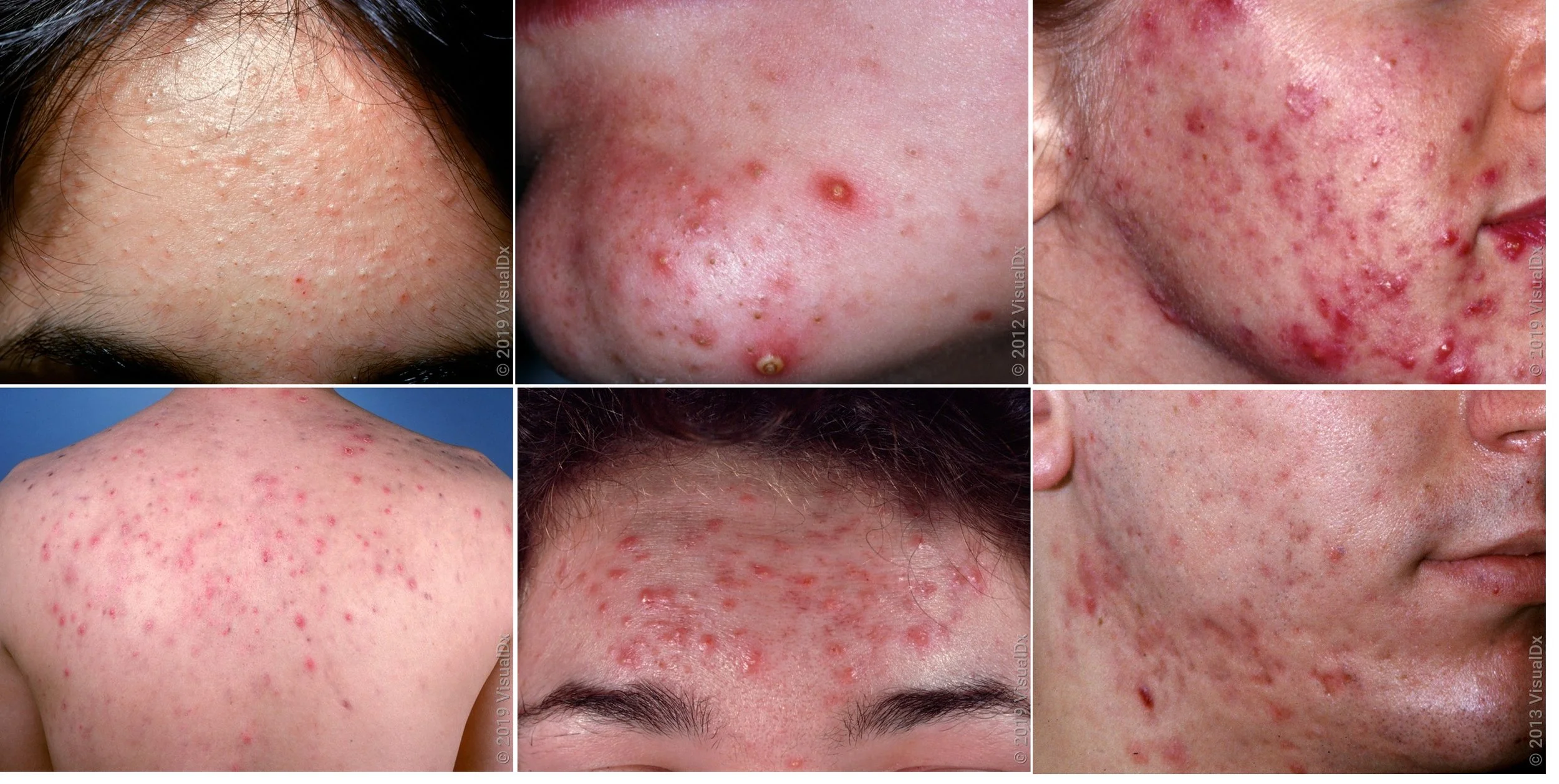 Cumbres Dermatológico San Luis Potosi Dermatologo Dr Manuel Soria Acné
