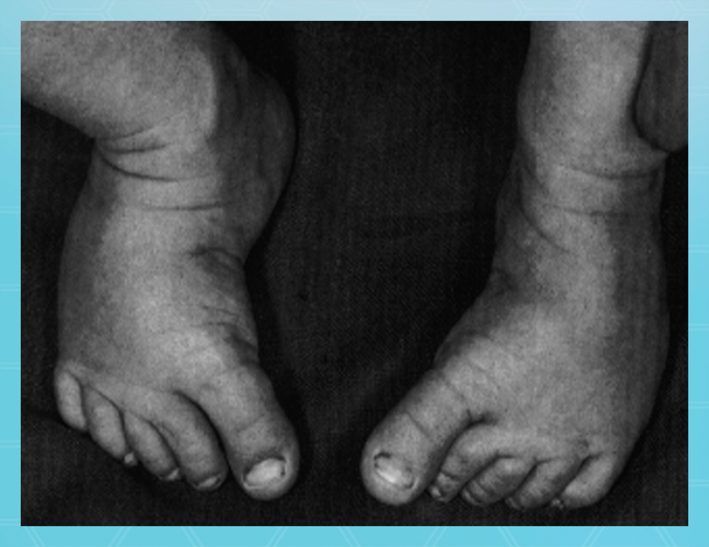 pé metatarso varo (metatarso aduto) - Um guia para os pais — Orthokids