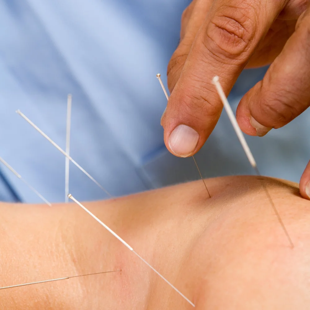 Acupuncture of Shawano