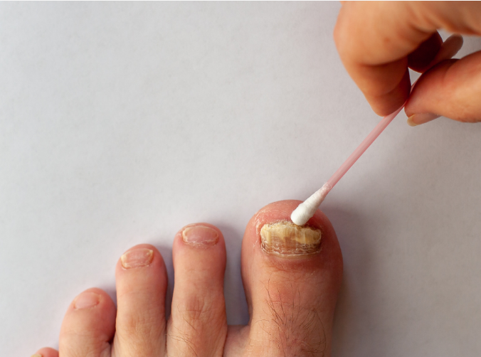 What is a fungal toenail? — Ace Feet Podiatry – Professional Foot Care ...