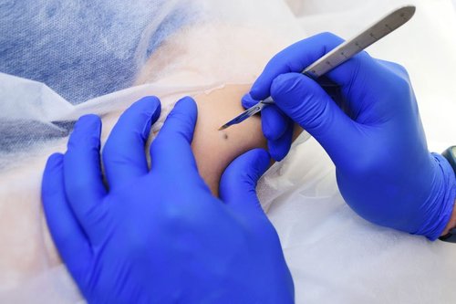Surgical Dermatology | Schedule Your Consultation Now — Advanced ...