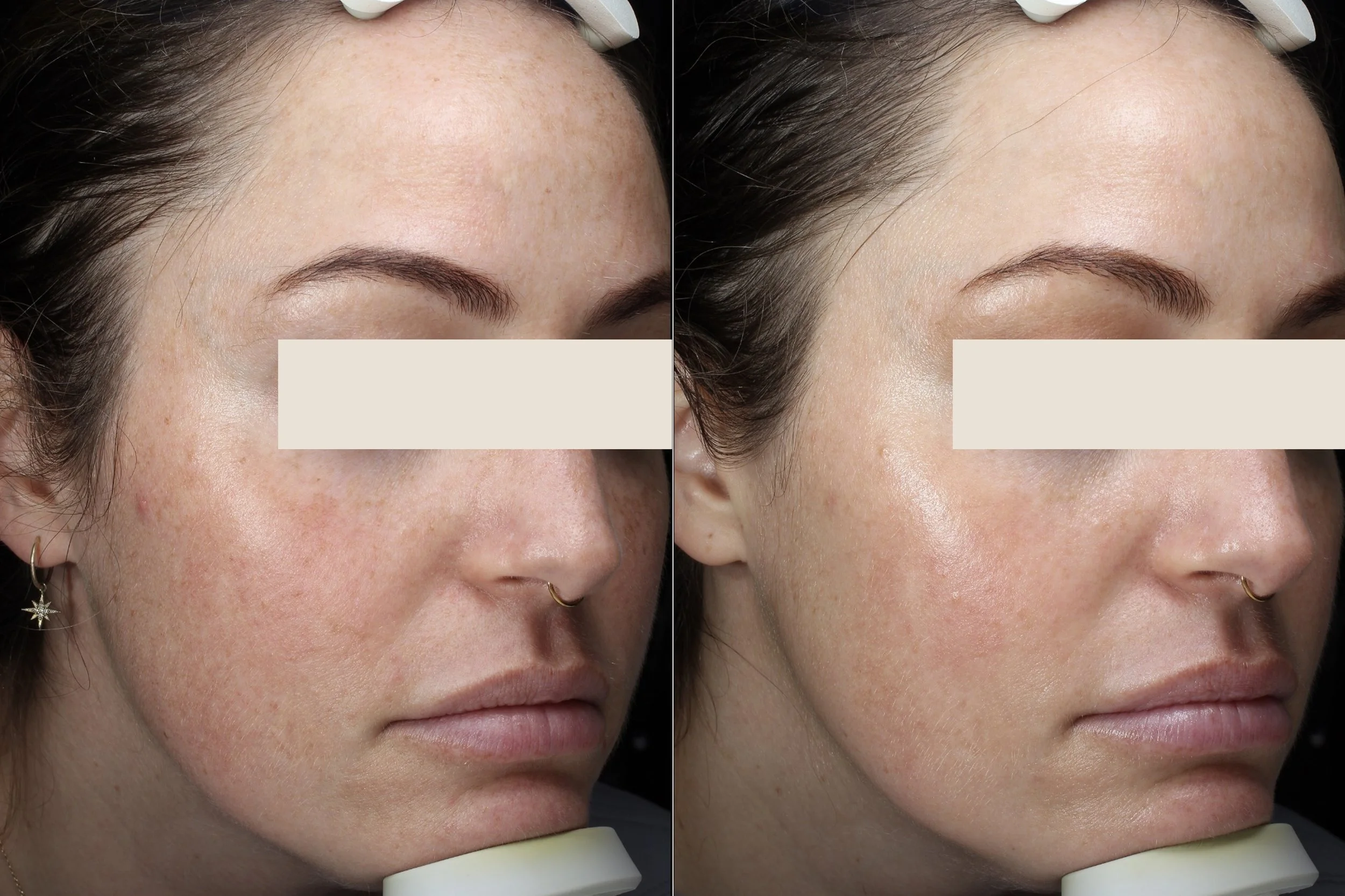 Pigmentation — Northern Sydney Dermatology NSDL | Cosmetic Laser ...