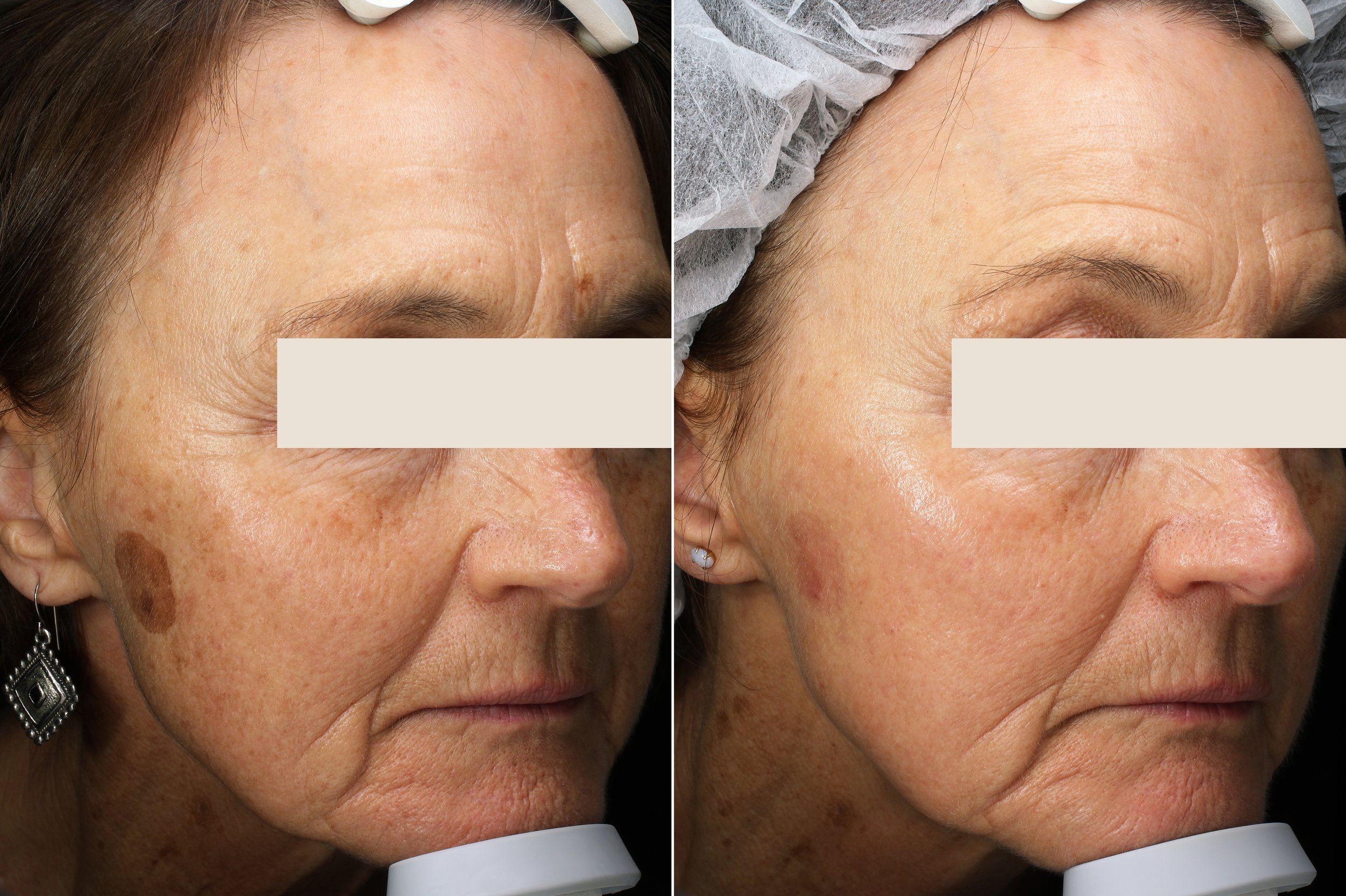 Pigmentation — Northern Sydney Dermatology NSDL | Cosmetic Laser ...