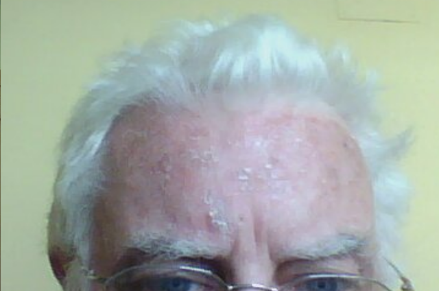 Actinic Keratosis Types and Treatment in Naples, FL — Naples Dermatology