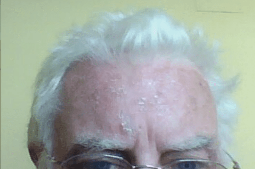 Actinic Keratosis Types and Treatment in Naples, FL — Naples Dermatology