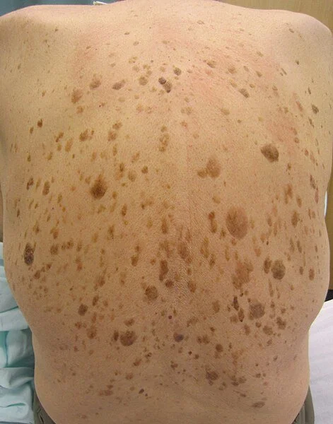 Seborrheic keratoses — Naples Dermatology