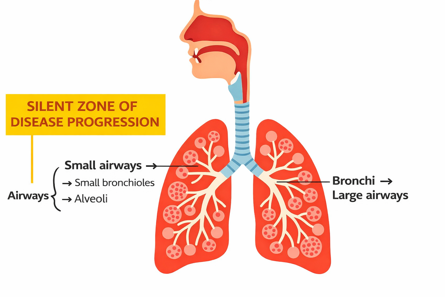 Why is asthma prevention and treatment difficult? Small airway ...