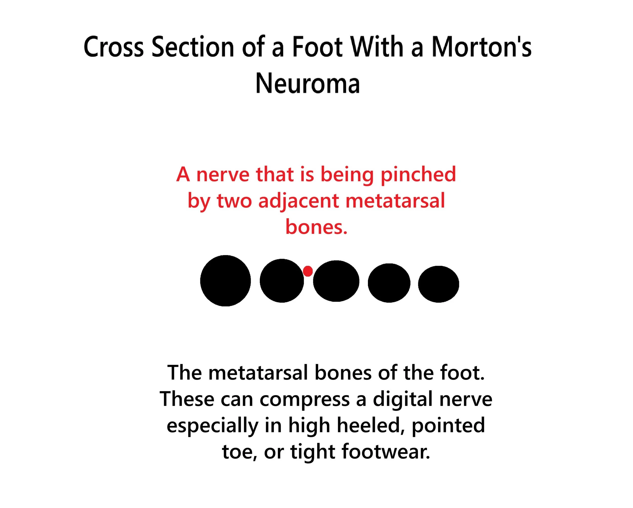 Morton's Neuroma Barks Pedorthics Metatarsal Pad — Barks Pedorthics