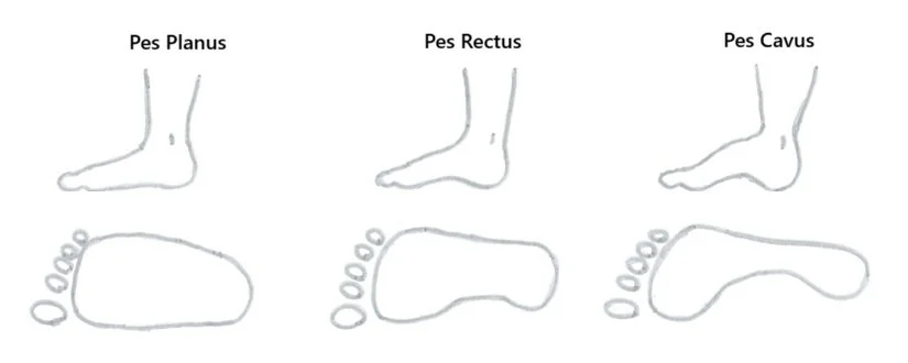 https://www.barkspedorthics.ca/blog/High-Arches-Flat-Feet-Surface-Area ...