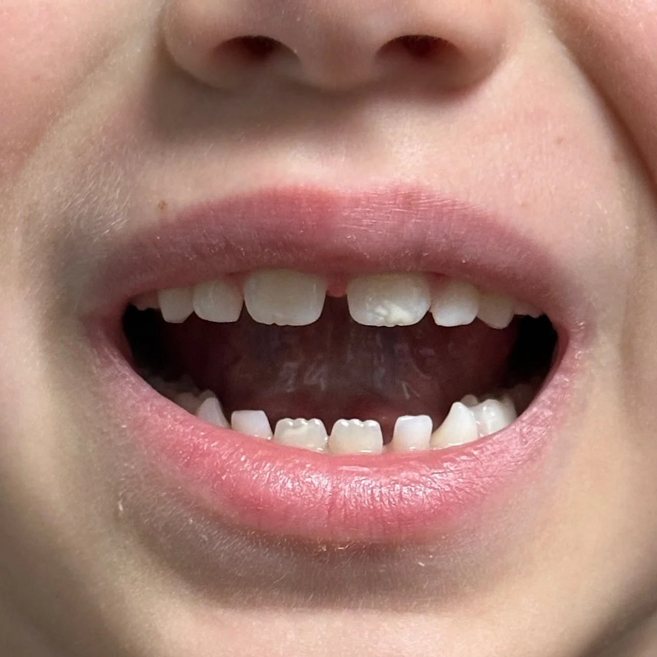 Understanding Lisps: A Parent’s Simple Guide to Clearer Speech ...