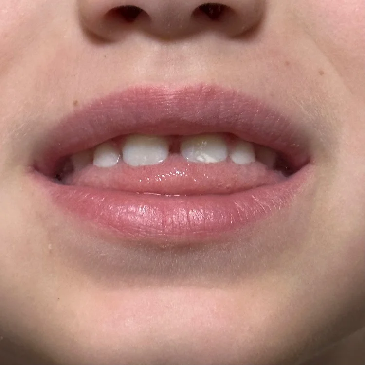 Understanding Lisps: A Parent’s Simple Guide to Clearer Speech ...