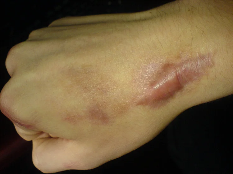 Types of Skin Scarring & Treatments | Manage Keloids, Indentations, and ...