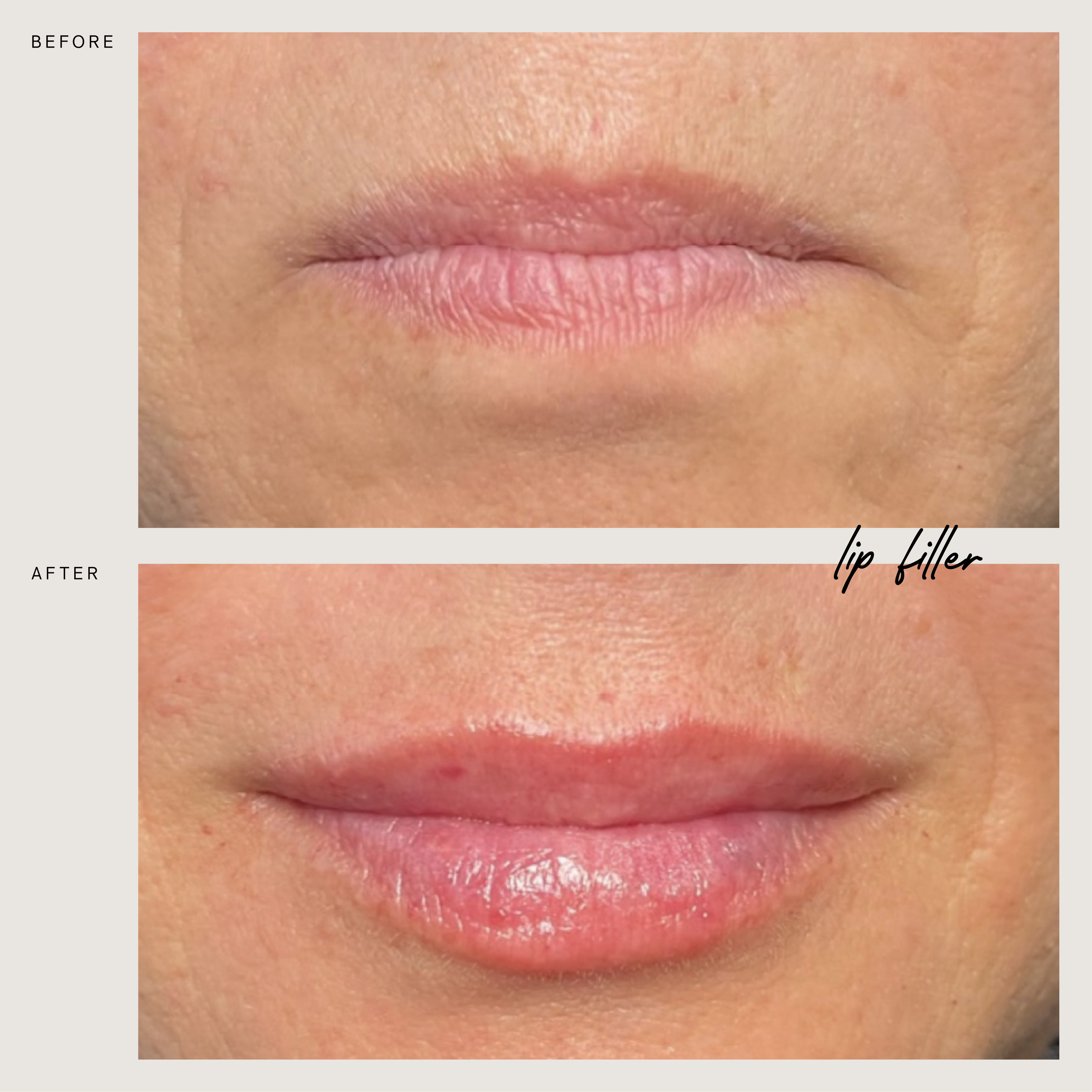 Dermal Filler — Odara Medical Spa