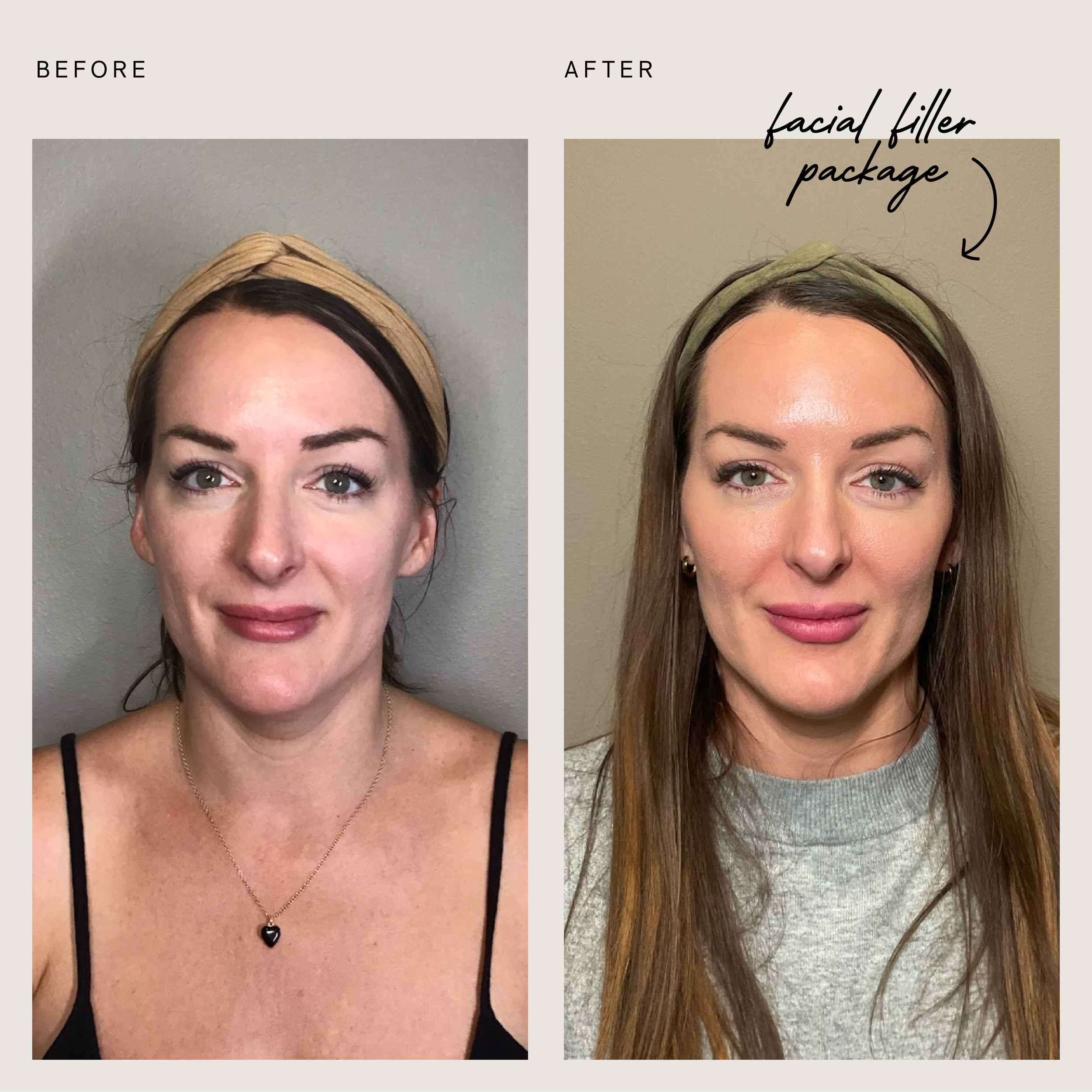 Dermal Filler — Odara Medical Spa
