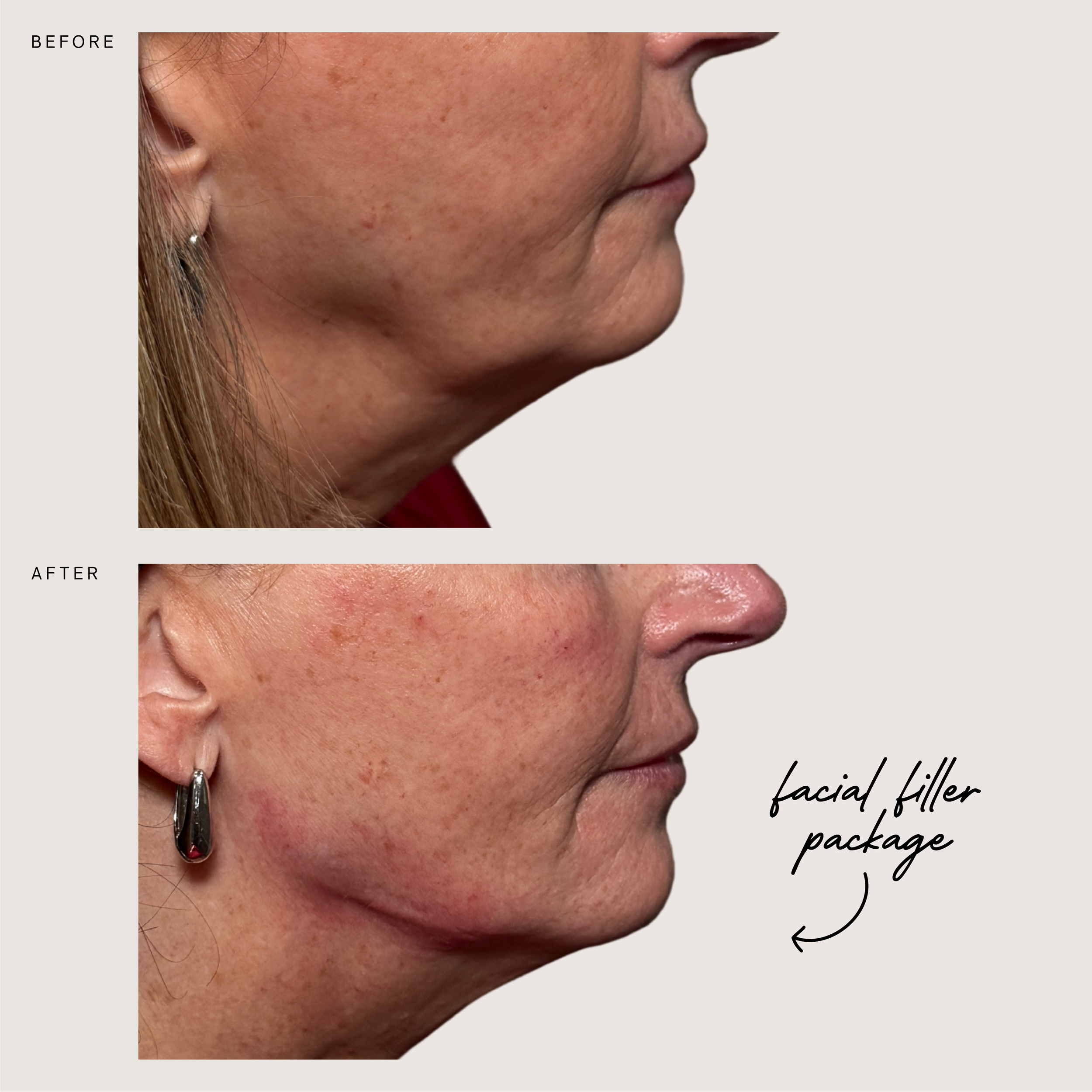 Dermal Filler — Odara Medical Spa