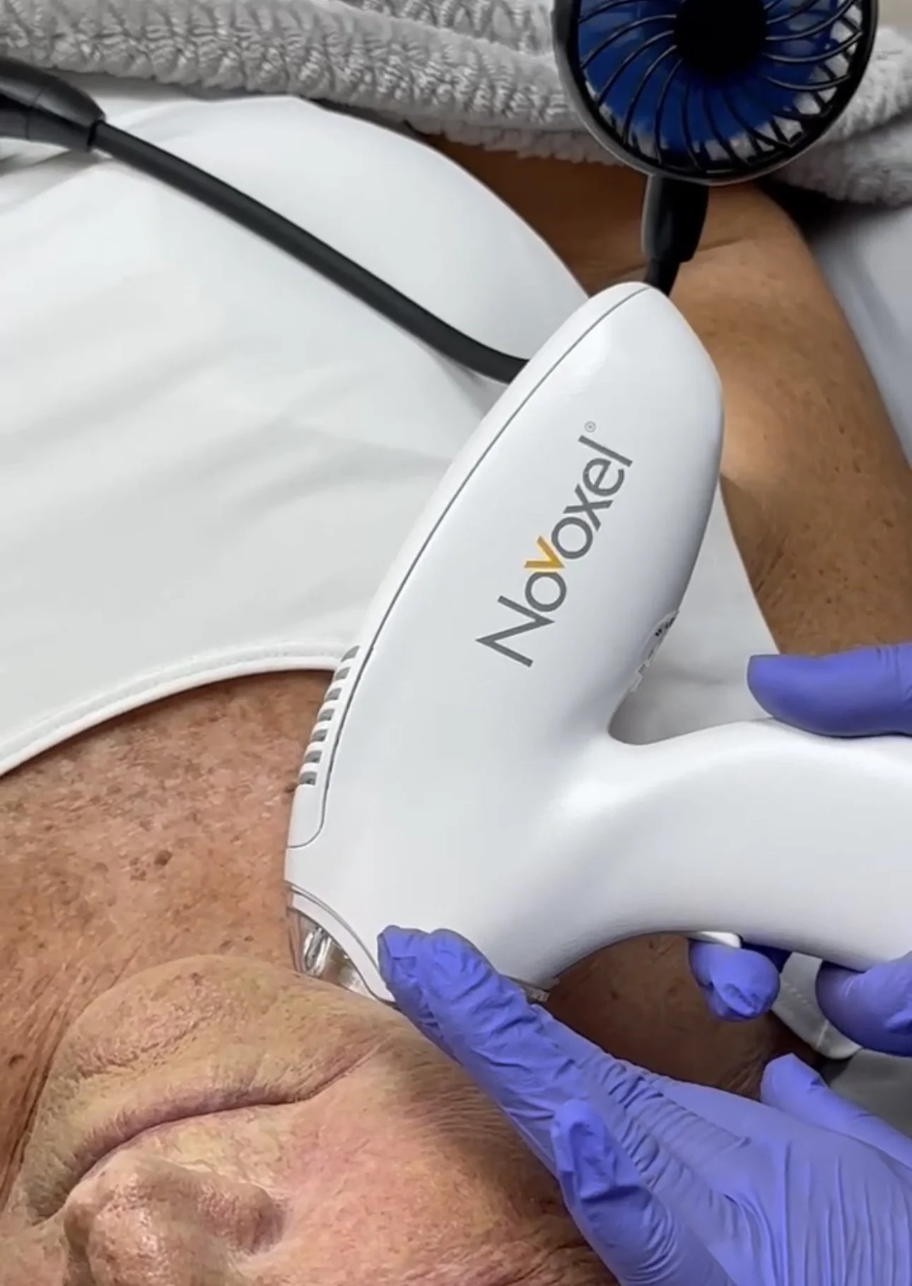 Tixel Before & After Portfolio | Marco Island Aesthetics — Marco Island Aesthetics