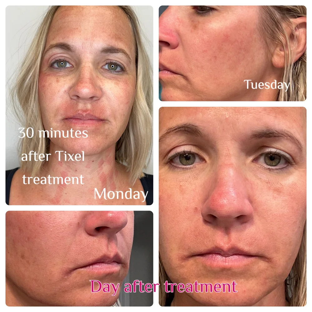 Tixel Before & After Portfolio | Marco Island Aesthetics — Marco Island ...