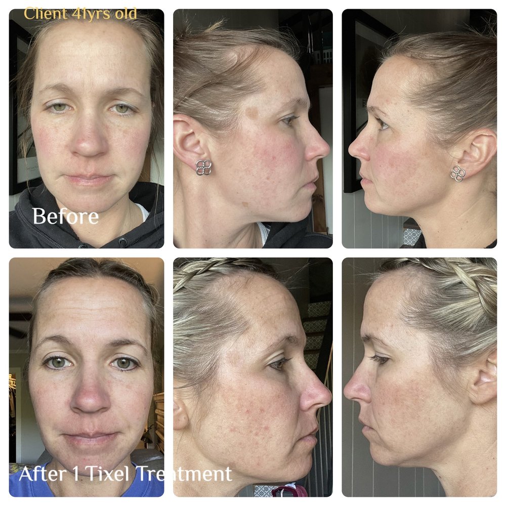 Tixel Before & After Portfolio | Marco Island Aesthetics — Marco Island ...