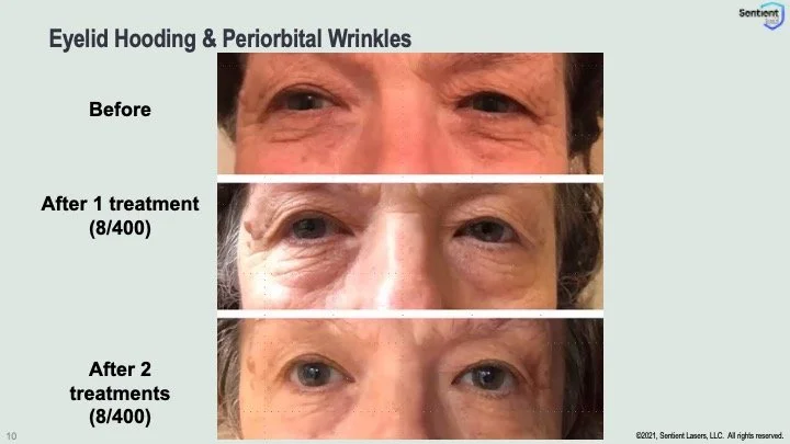 Tixel Before & After Portfolio | Marco Island Aesthetics — Marco Island ...