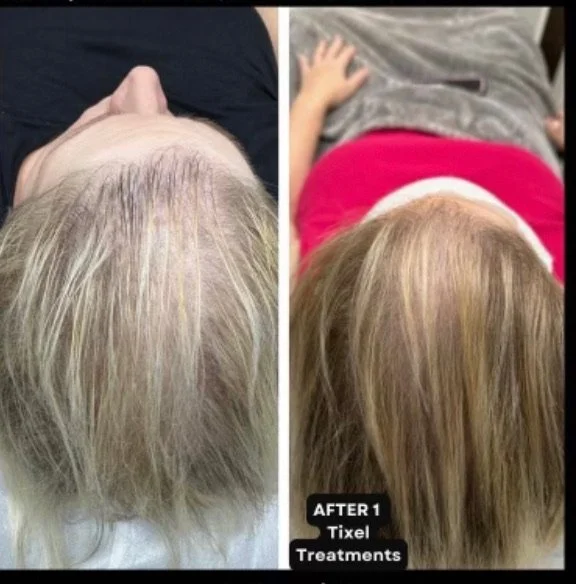 Tixel Before & After Portfolio | Marco Island Aesthetics — Marco Island ...